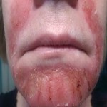 Efudex and Topical Chemotherapy Images for Skin Cancer