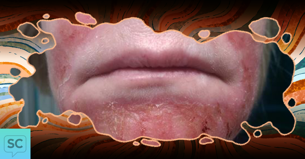 Efudex and Topical Chemotherapy Images for Skin Cancer