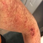 Efudex and Topical Chemotherapy Images for Skin Cancer