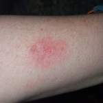 Efudex and Topical Chemotherapy Images for Skin Cancer