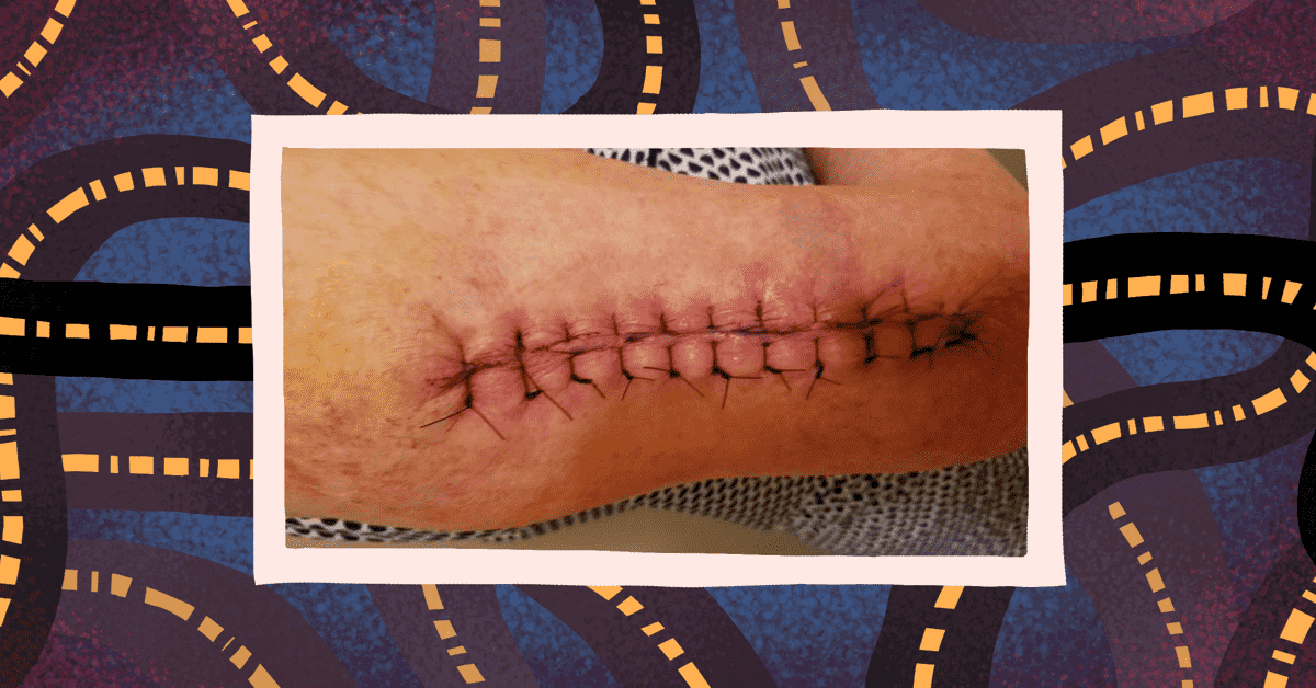 Can Basal Cell and Squamous Cell Carcinoma Spread?