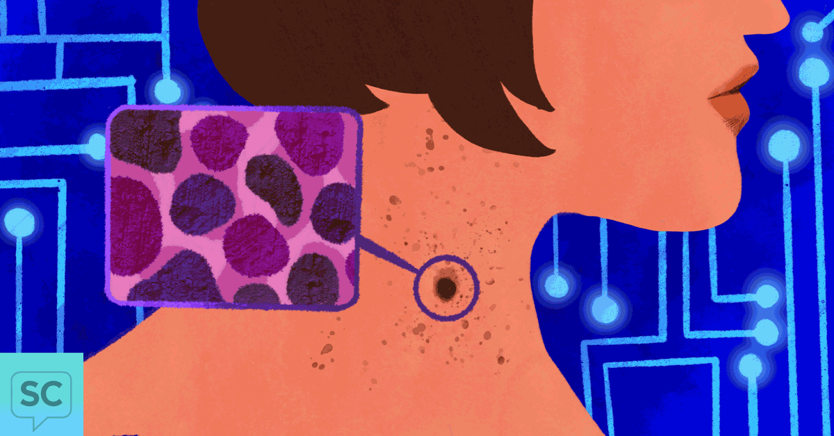 Artificial Intelligence and Melanoma Metastases | SkinCancer.net Artificial Intelligence and Melanoma Metastases | SkinCancer.net